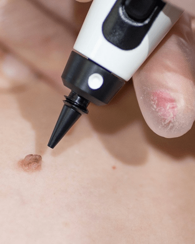 New Cryoprobe for treatment of precancerous lesions in the comfort of ...